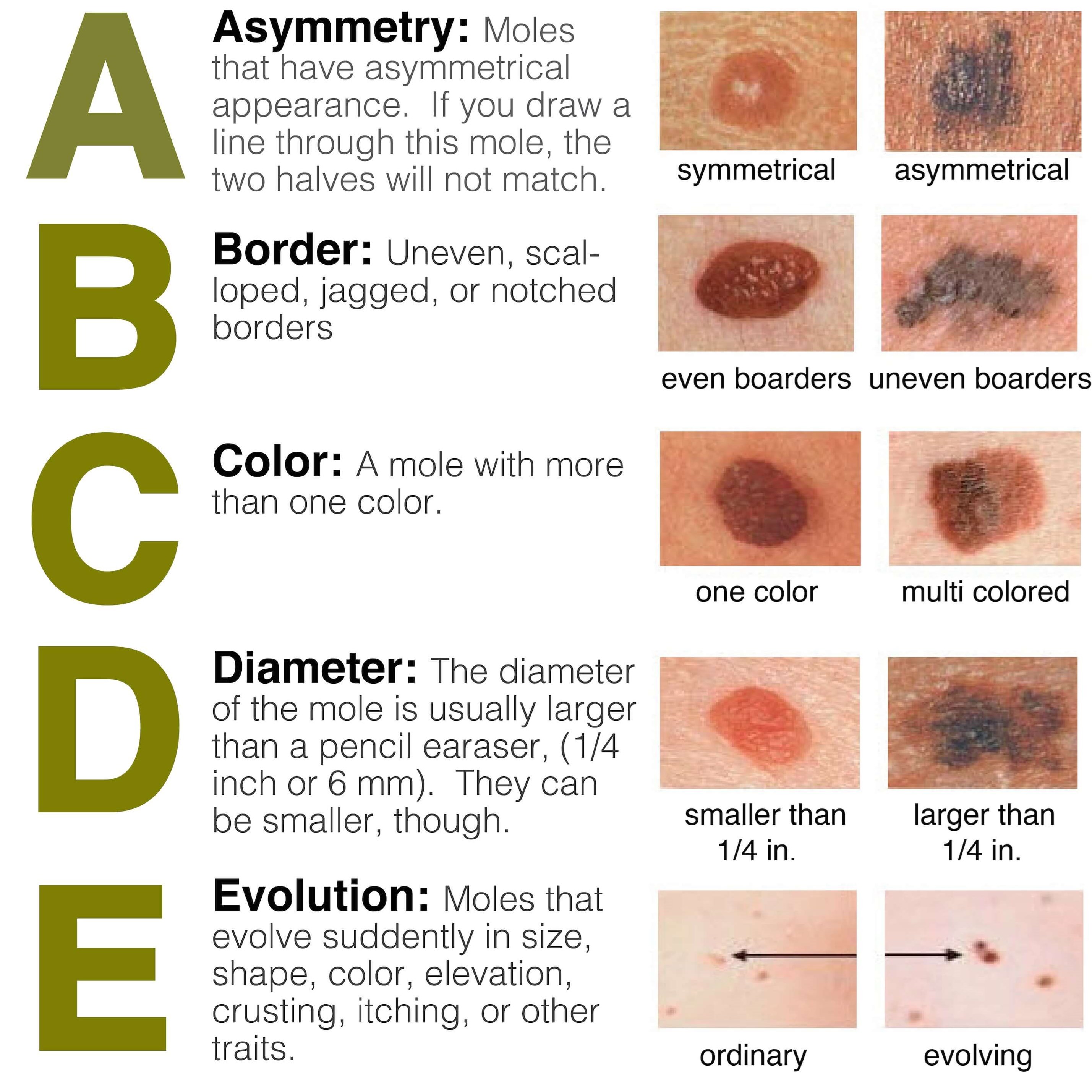 Melanoma Warning Signs And Images The Skin Cancer Fou Vrogue co