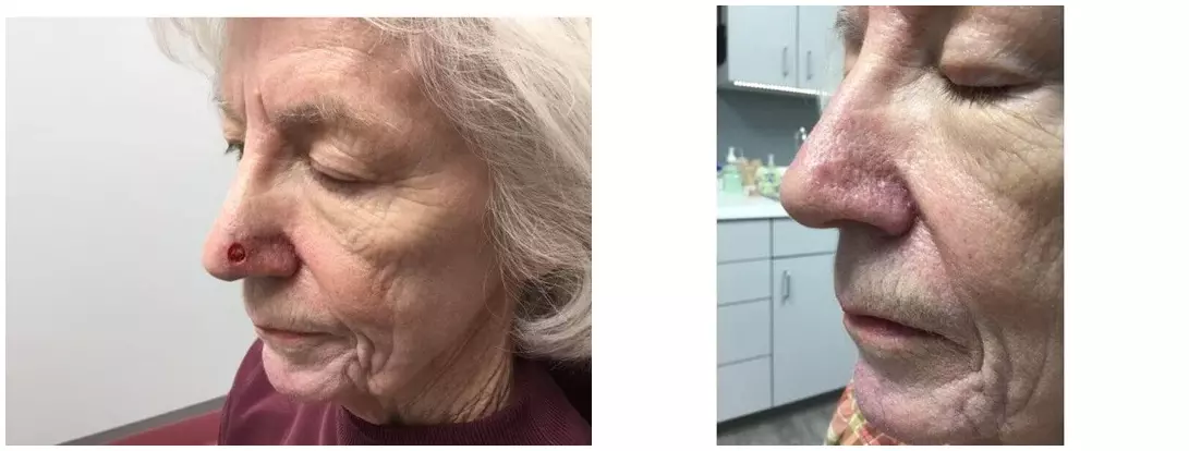 Mohs Skin Surgery / Squamous Cell Carcinoma - Dermatology Institute Mohs Skin Surgery / Squamous Cell Carcinoma - Dermatology Institute
